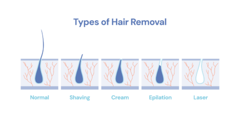 7 Tips for a Comforable Laser Hair Removal | Emla